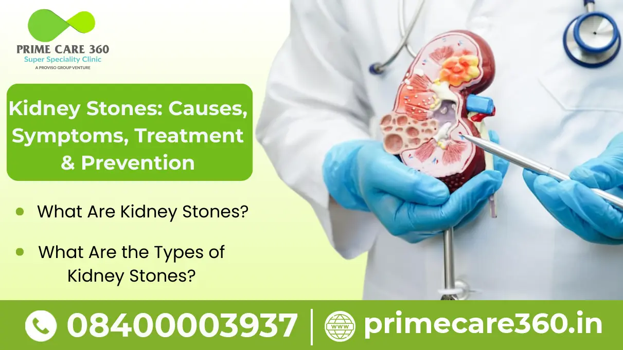 Kidney Stones: Causes, Symptoms, Treatment & Prevention